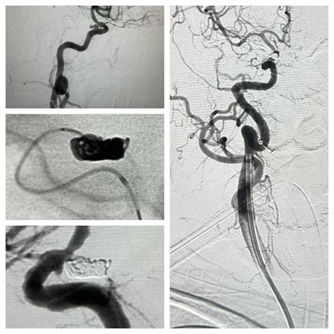 Kalyan Sajja On Linkedin 42 Year Old With Ruptured Pcom Aneurysm