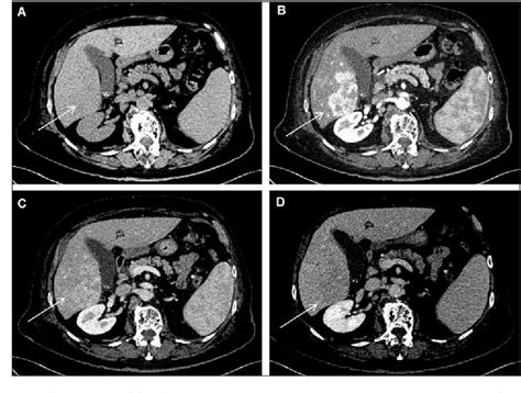 Figure 3 From Enhancement Patterns Of Intrahepatic Mass Forming