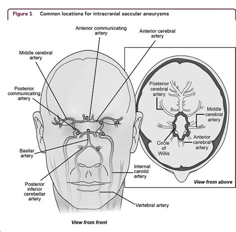 Figure 1 From Management Of Unruptured Intracranial Aneurysms Semantic Scholar