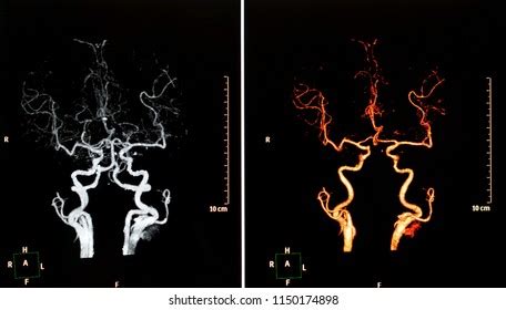 Ct Angiography Brain Stock Photo Shutterstock