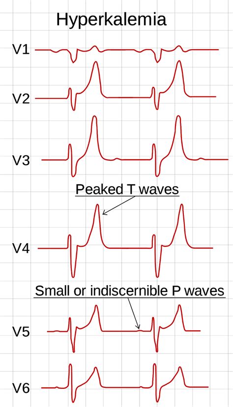 Ecg Afwijkingen Bij Hypo En Hyperkaliemie Acute Zorg Blog