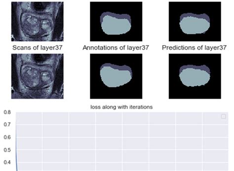 3d Zonal Segmentation Of The Prostate Mri Deep Learning Final Project