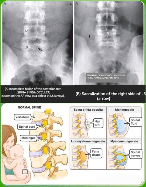 Dr Omid Bandarchi M D On Twitter 🔴answer🔴 A Incomplete Fusion Of Posterior Arch Spina