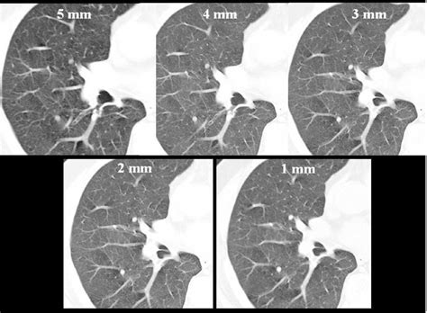 Detección Y Caracterización Del Nódulo Pulmonar Por Tomografía Computarizada Multicorte Radiología