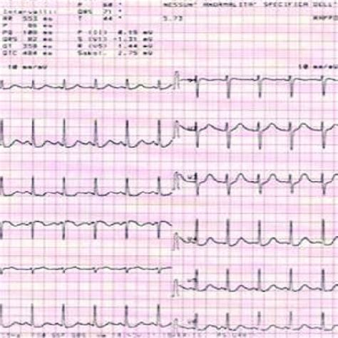 Electrocardiogram Was Suggestive Of Subendocardial Ischemia In Download Scientific Diagram