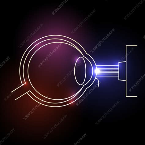 Laser Eye Surgery Illustration Stock Image F0438011 Science