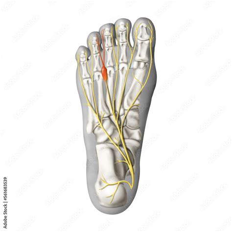 Стоковая иллюстрация «지간신경종 해부학 메디컬일러스트 Adobe Stock