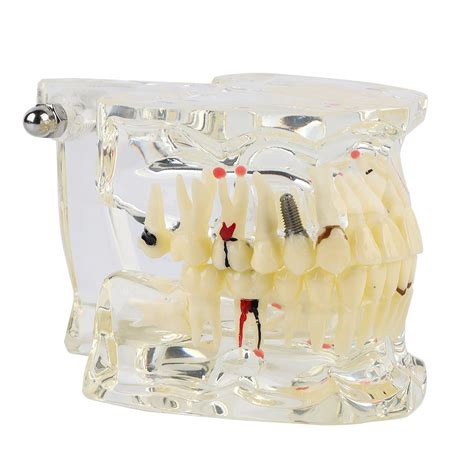 Buy Denture Tooth Model Plastic Tooth Model Pathological Dental Caries