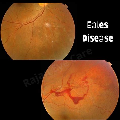 Madhuvanthi Mohan On Linkedin Eales Disease