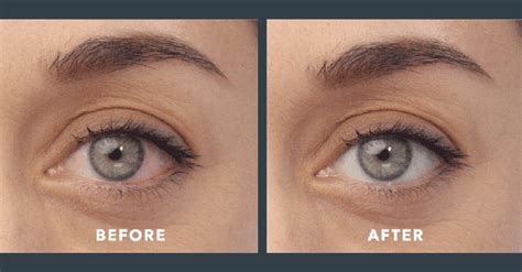 The Benefits Of Lumify® Eye Drops For Redness Relief