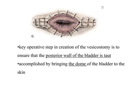 Etiopathogenesis Evaluation And Management Of Posterior Urethral Valve