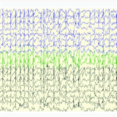 Electroencephalographic Recording Referential Derivations With Sleep