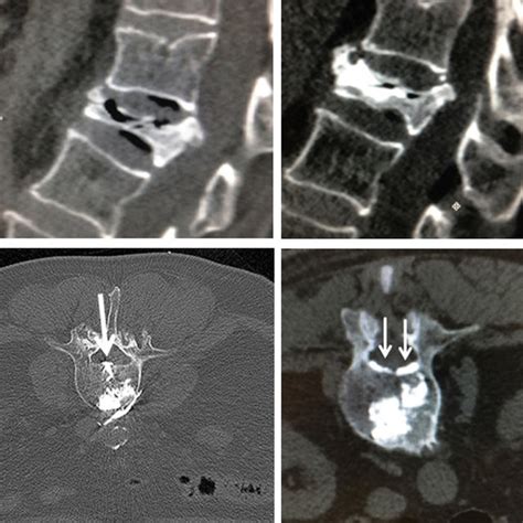 Patient With Compression Fracture Of The L Vertebral Body A Download Scientific Diagram