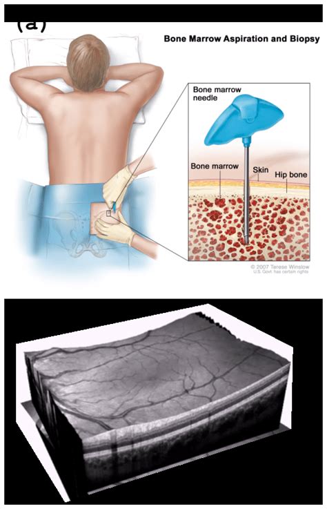 Physical Biopsy Versus Optical Biopsy A An Example Of A Physical