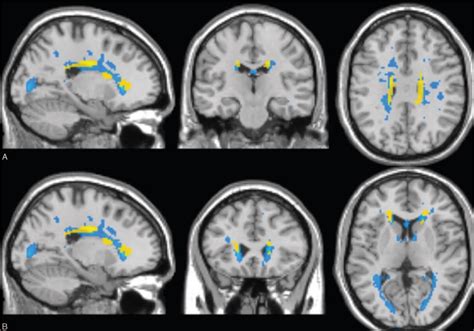 Voxelwise Morphometry Analysis Results Obtained Using Fractional