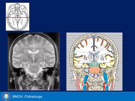 Cochlear Implant Imaging Ppsx