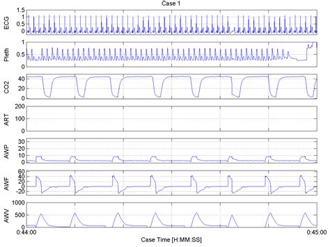 Case 1 Waveform Plots 60 Second Plots