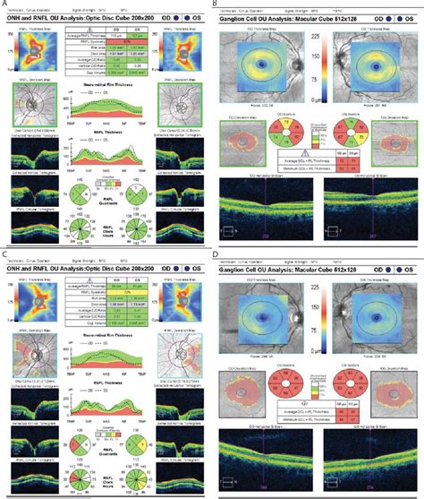 Spectral Domain Optic Coherence Tomography Download Scientific Diagram