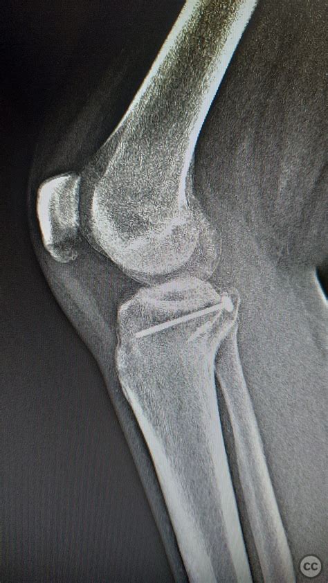 Tibia Pcl Avulsion Fracture