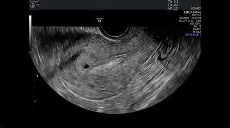 Voluson™ P8 Ultrasound System Ge Healthcare