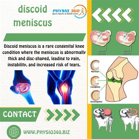A Discoid Meniscus Is A Congenital Knee Condition Where The Meniscus A