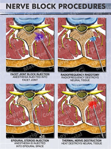 Nerve Block Procedures Order