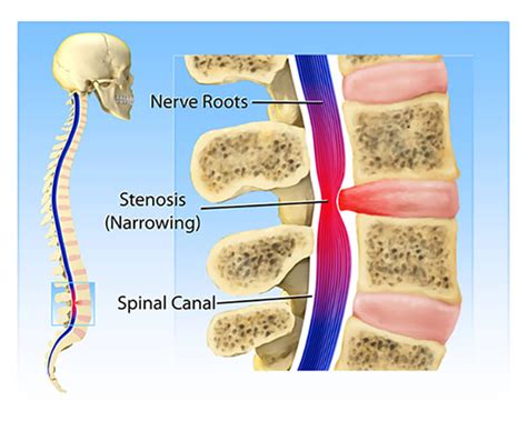 Spinal Stenosis