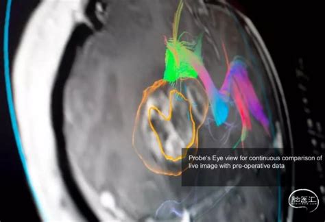 【会议学习班】brainlab Curve导航联合蔡司kinevo 900增强虚拟现实新技术助力脑网络神经外科手术 脑医汇