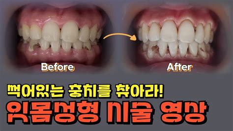 숨어있는 충치 치석을 원활하게 치료하기 위한 잇몸성형 시술 영상 Youtube