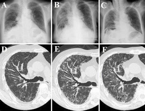 Figure2 Lung Involvement Visible On Chest X Ray Radiography And