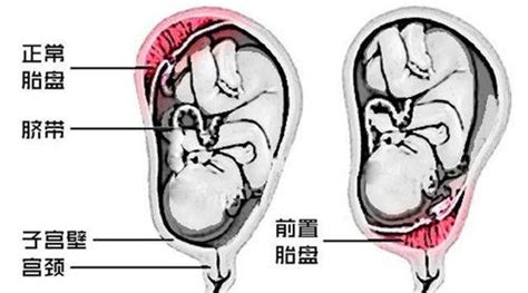 胎盘前置多图 39医疗图集 39健康网