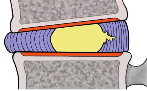 Understanding Sciatica Tom Jesson Books