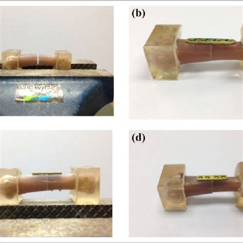A Transverse Fracture B Transverse Midshaft Metacarpal Fracture Download Scientific