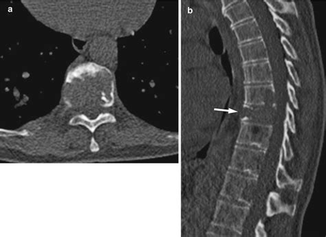 Benign Versus Malignant Vertebral Fractures Radiology Key