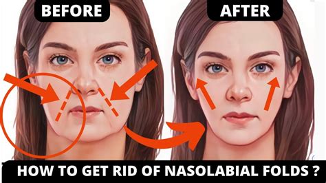 Min How To Get Rid Of Nasolabial Folds With Face Yoga How To Lift Sagging Skin Jowls