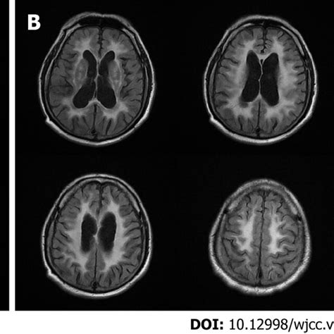 T2 Weighted T2 Fluid Attenuated Inversion Recovery And Download Scientific Diagram