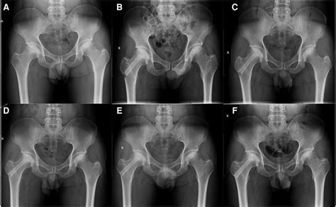 Frontiers Core Decompression Vs Allogenic Non Vascularized Bone