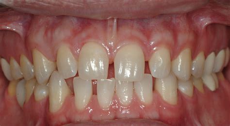 Class I Malocclusion Anterior Open Bite Dental Spacin Vrogue Co