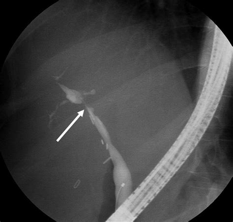 Biliary Stricture And Negative Cytology What Next Clinical