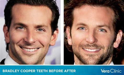 Bradley Cooper Teeth