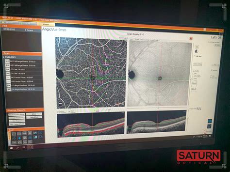 Optovue Solix Oct Angiography Saturn Optical