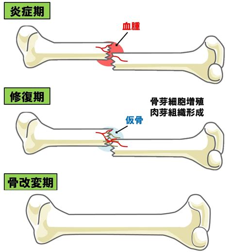 【基礎から学ぶ】骨折の治癒機転【整形外科学】 Ptot国試対策 ー西島ゼミー