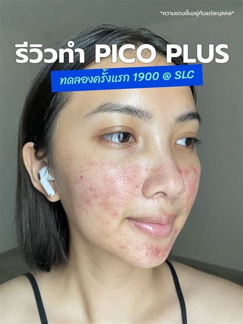 รีวิวทำ Pico Plus Laser ทดลองครั้งแรก 1900 บาท ดีจริงไหม แกลเลอรีที่โพสต์โดย ม๋ามายด์ 🥨🐶 Lemon8