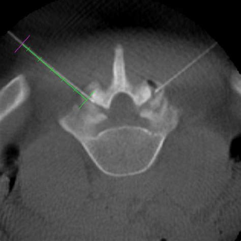 Live 3d Guidance In The Interventional Radiology Suite Ajr
