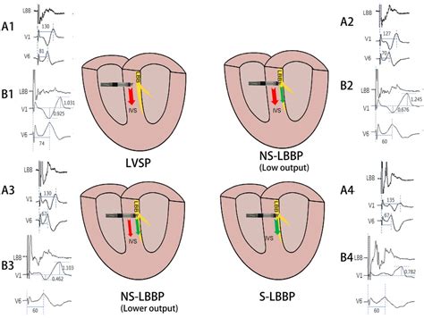 Frontiers Corrigendum Guidance On Left Bundle Branch Pacing Using Continuous Pacing Technique