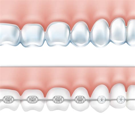 Исправление прикуса в стоматологии StepDental