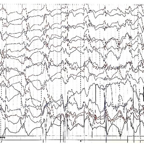 Three Month Prior Electroencephalogram Eeg Of A Patient With Epilepsy