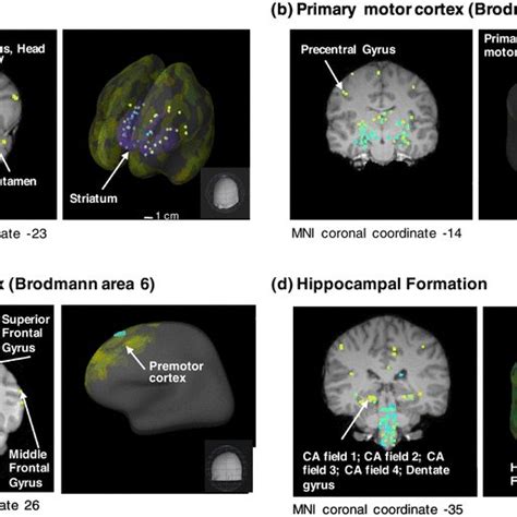 Htt Gene Cag Triplet Repeat Expansions In Huntingtons Disease Hd