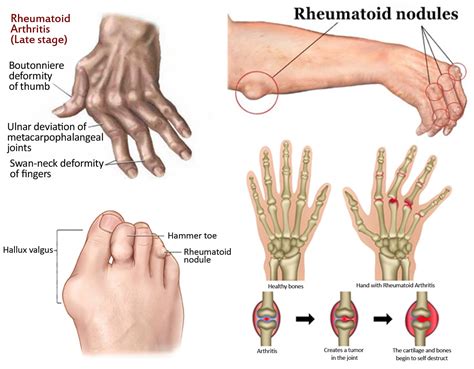 Rheumatoid Nodules Palms
