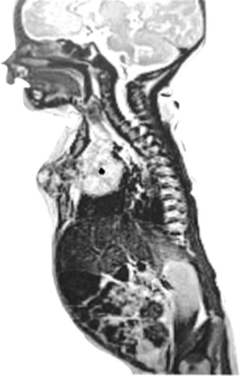 Magnetic Resonance Image Shows A Sagittal View Of The Presternal